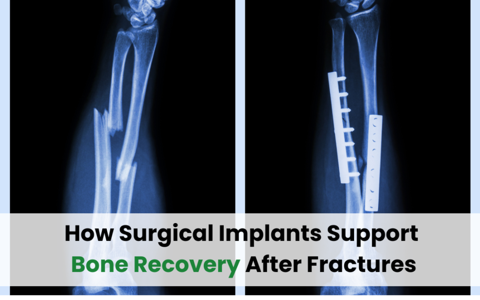 How Surgical Implants Support Bone Recovery After Fractures - AOCARE